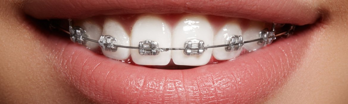 Clear Ceramic Braces Stow MA, Stow Orthodontics